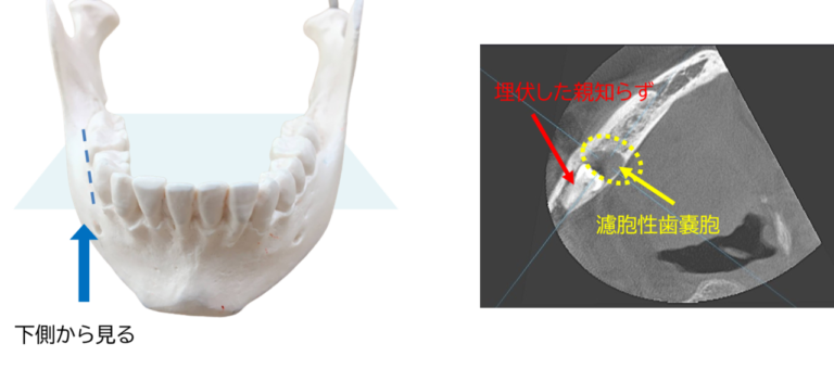 顎骨の中に袋！？～濾胞性歯嚢胞 | 船橋市東船橋の歯医者「ビバ歯科･矯正小児歯科」