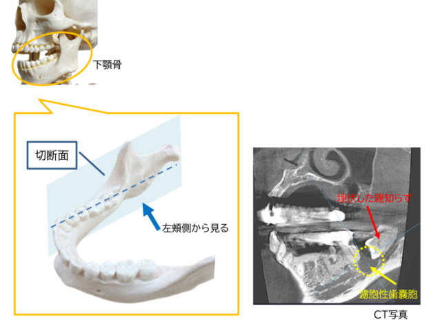顎骨の中に袋！？～濾胞性歯嚢胞 | 船橋市東船橋の歯医者「ビバ歯科･矯正小児歯科」